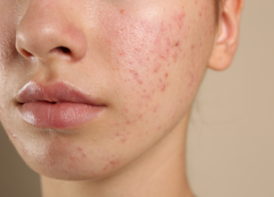 Tratamiento dermatitis atópica - Dermatología | IML Clinic