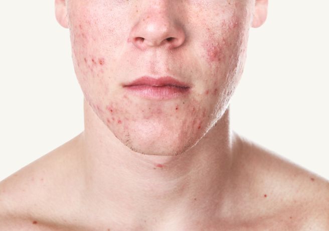 Eliminar el Acné, Tratamientos Estéticos | IML