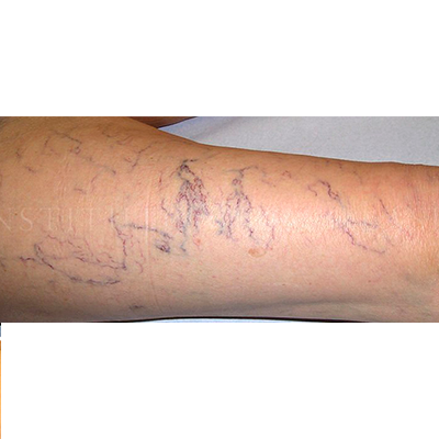 Foto antes y después del tratamiento de varices | IML