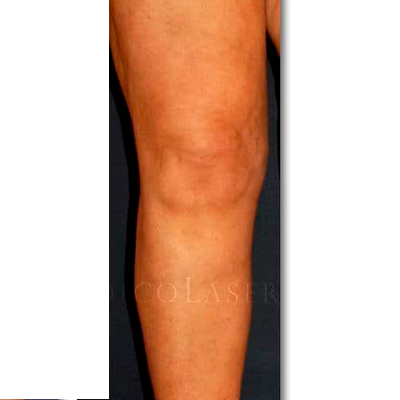 Antes y después del tratamiento de varices en las piernas | IML