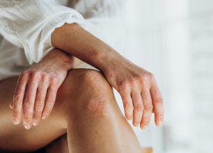 Psoriasis: tratamiento - Dermatología clínica | IML Clinic