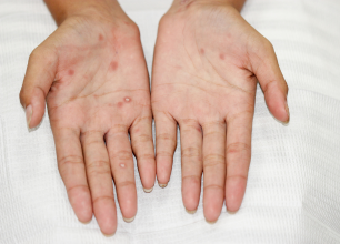 Tratamiento sífilis: enfermedades infecciosas| IML Clinic