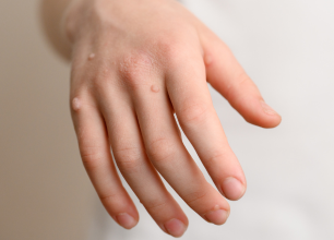 Virus del papiloma humano - VPH - Tratamiento | IML Clinic